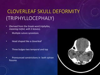 Craniosynostosis | PPT