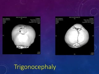 Trigonocephaly Ct Scan