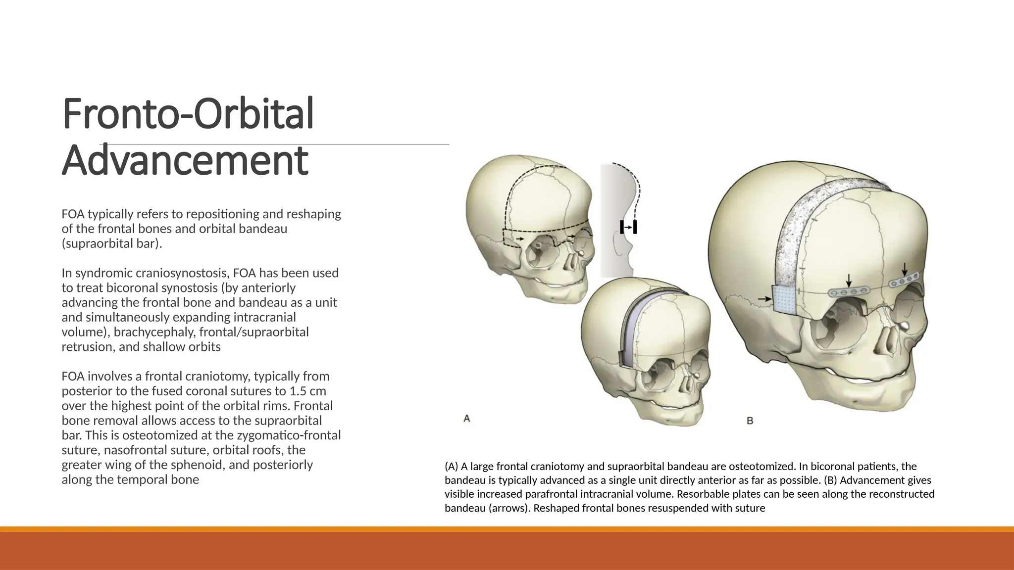Craniosynostosis treatment and diagnostic.pptx