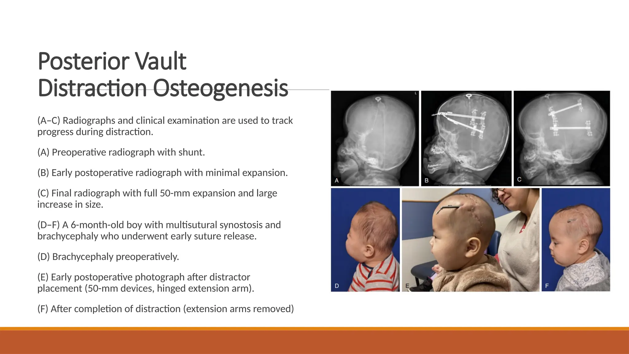 Craniosynostosis treatment and diagnostic.pptx