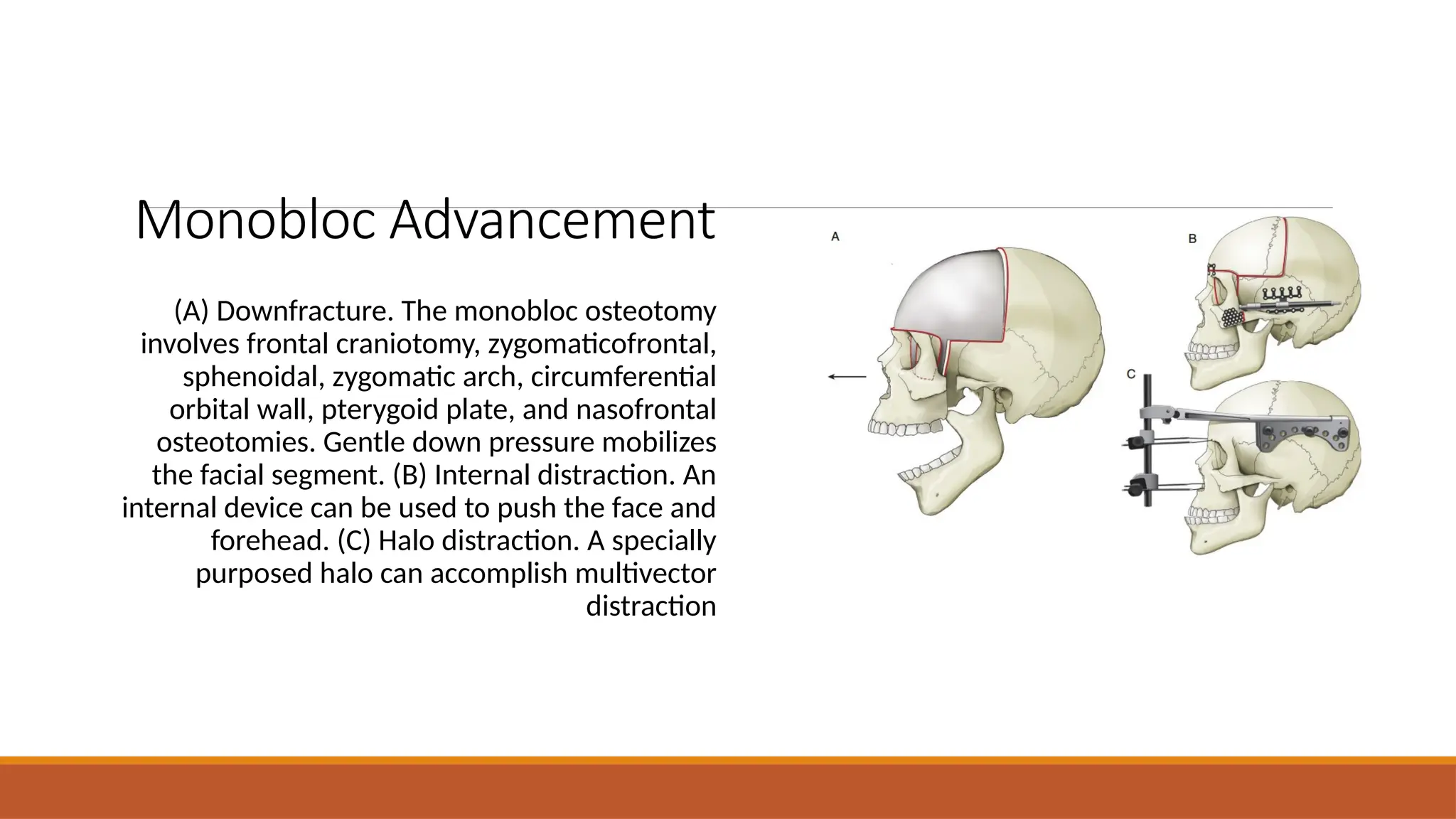 Craniosynostosis treatment and diagnostic.pptx
