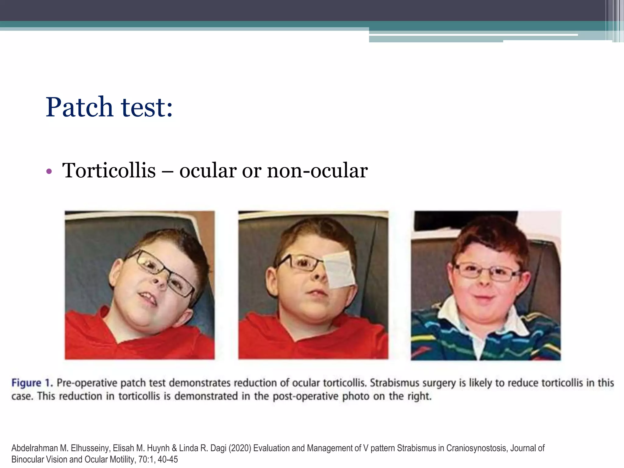 Craniosynostosis and strabismus | PPTX