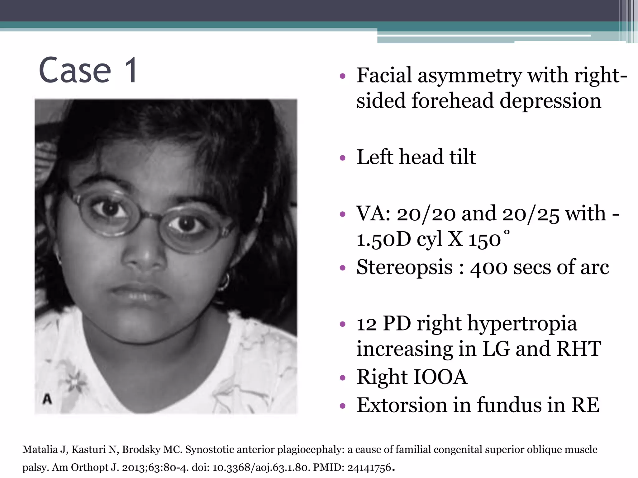 Craniosynostosis and strabismus | PPTX
