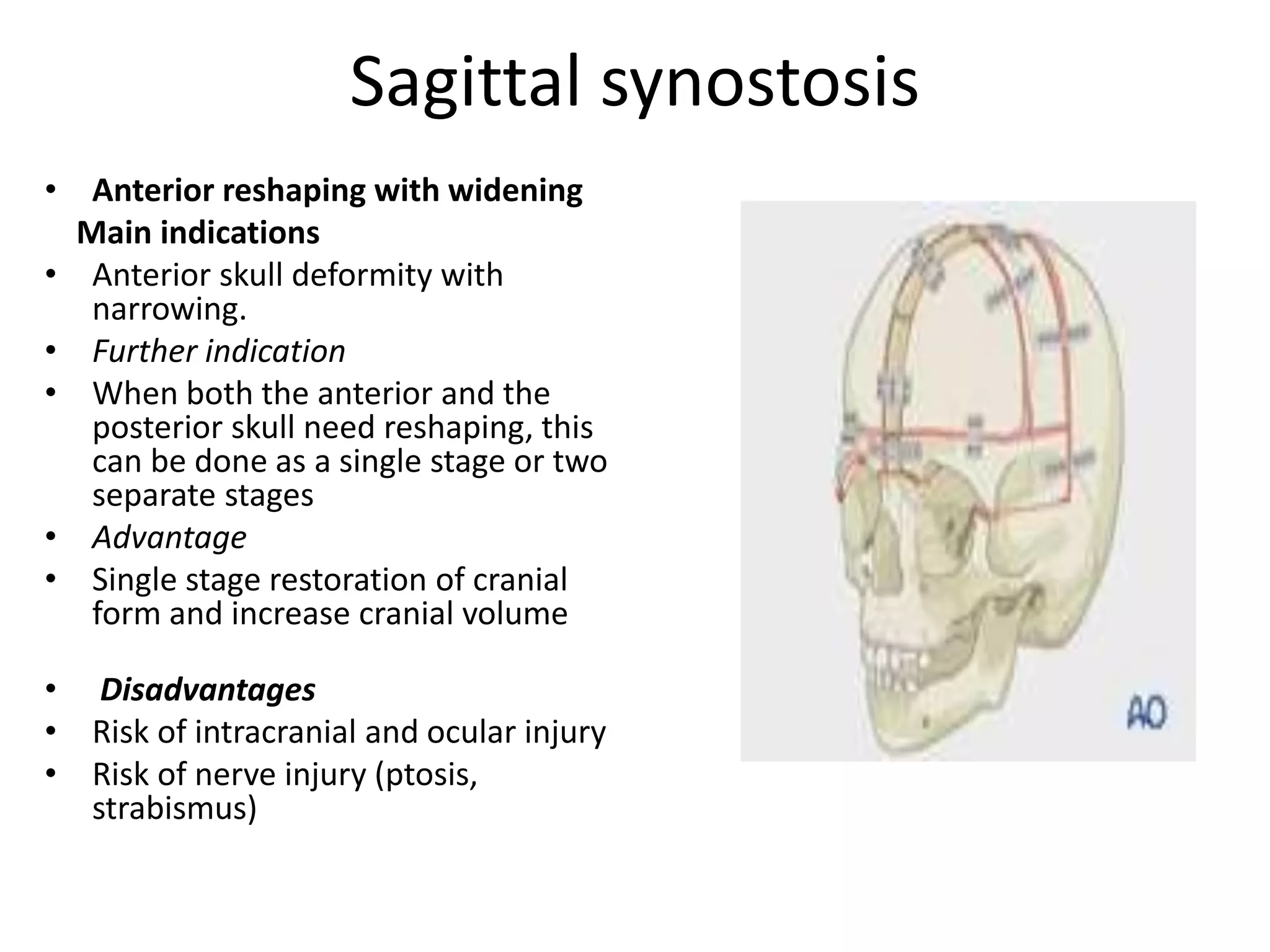 Craniosynostosis | PPTX