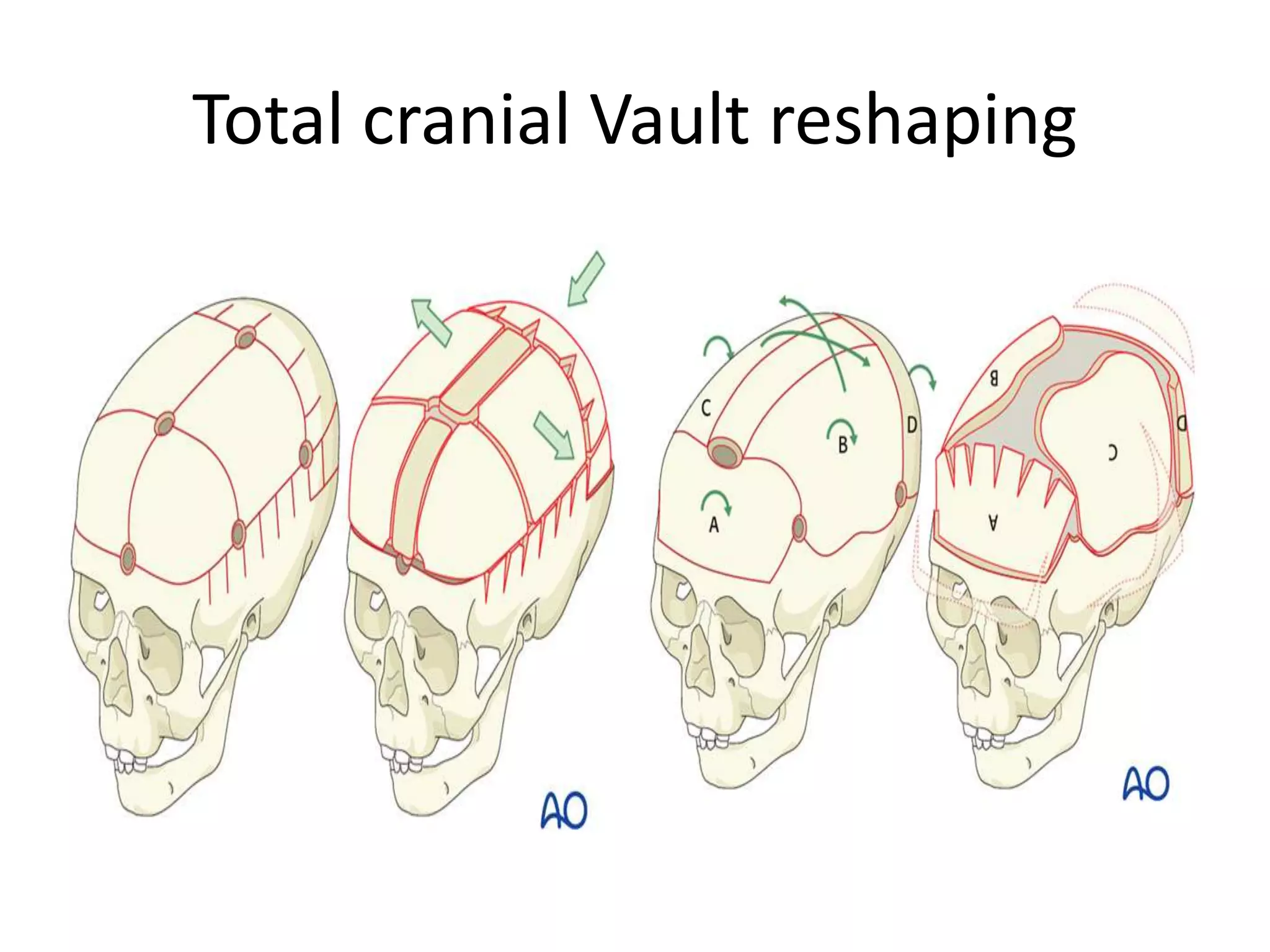 Craniosynostosis | PPTX