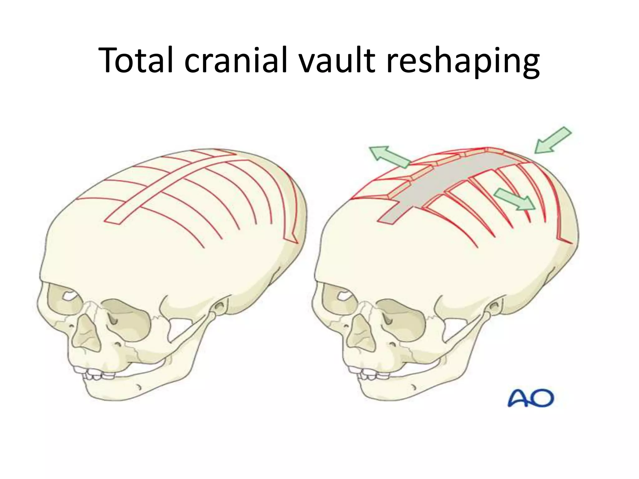 Craniosynostosis | PPTX