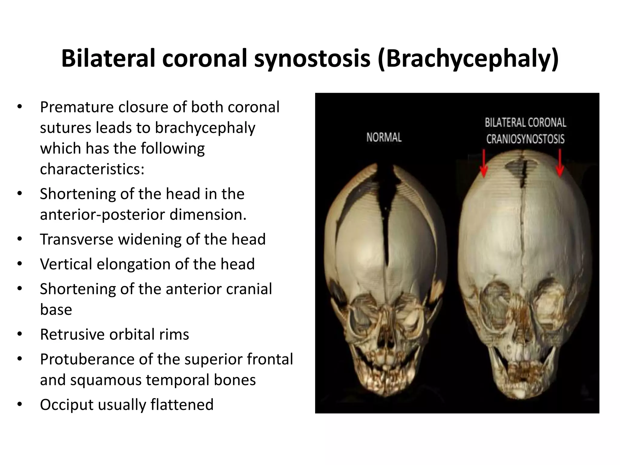Craniosynostosis | PPTX