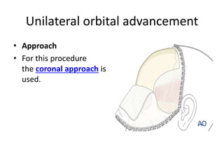 Coronal Approach