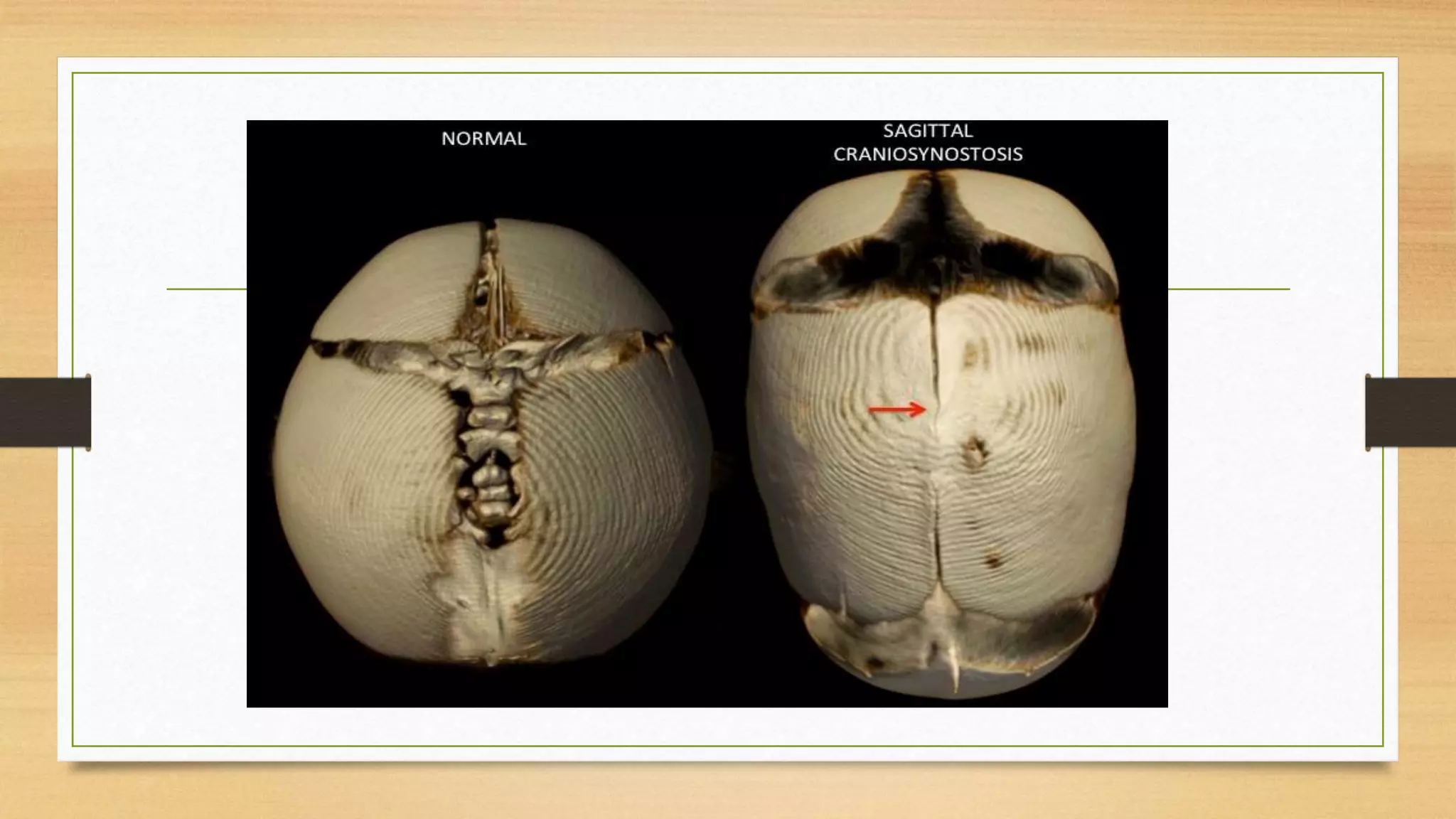Craniosynotosis | PPTX