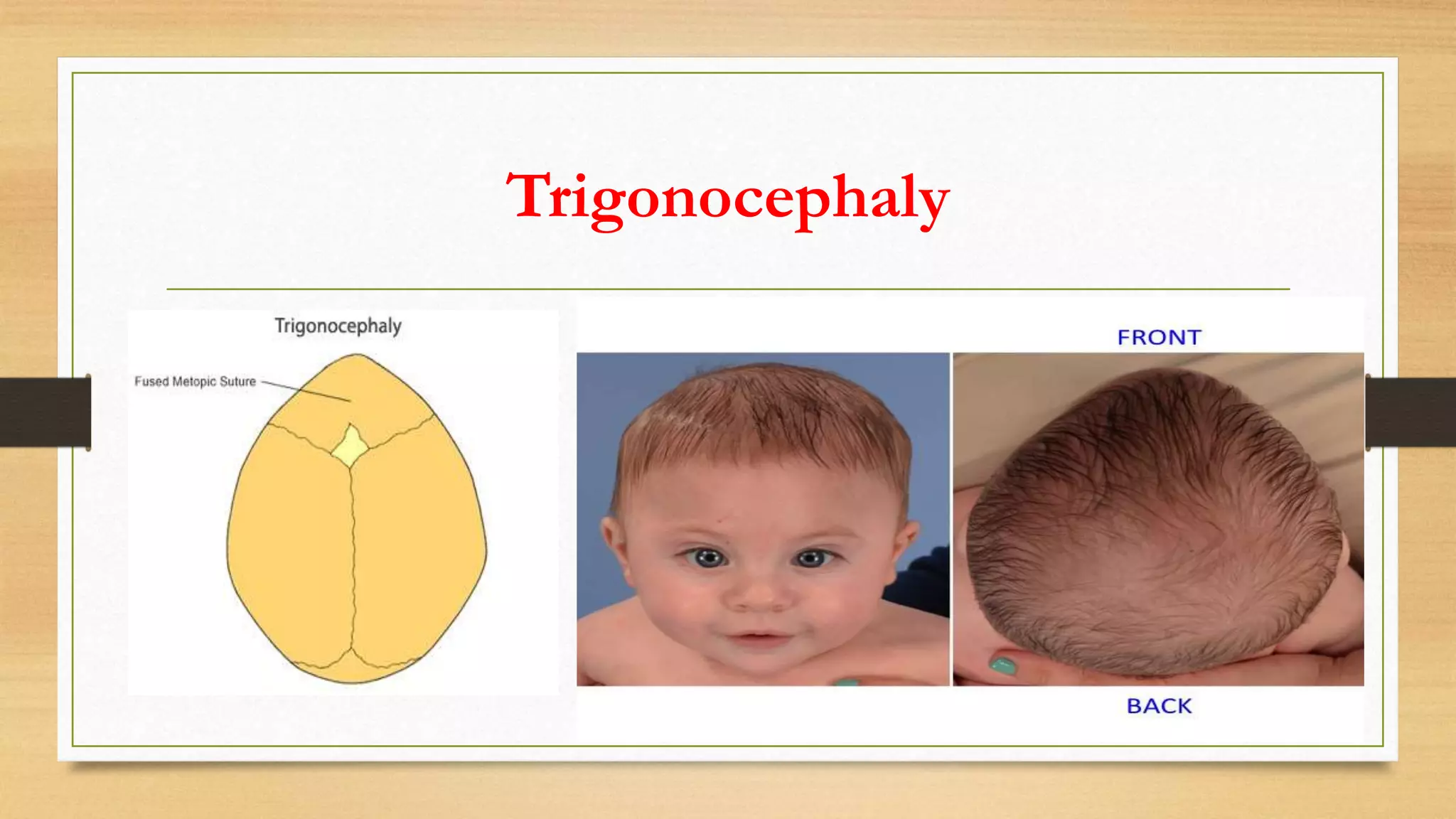 Craniosynotosis | PPTX