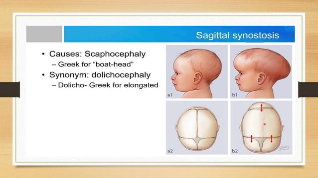 Craniosynotosis | PPTX | Pregnancy | Reproductive Health