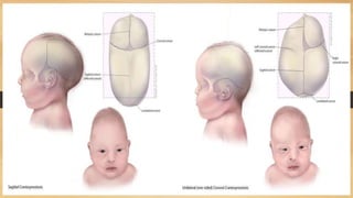 Craniosynotosis | PPTX