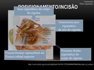Craniotomia orbito zigomatica | PPTX