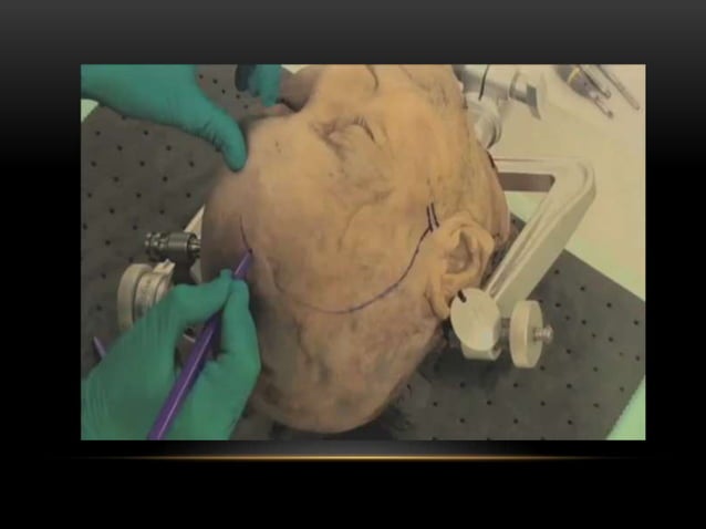 Craniotomia Pterional | PPTX | Surgery | Medical Health