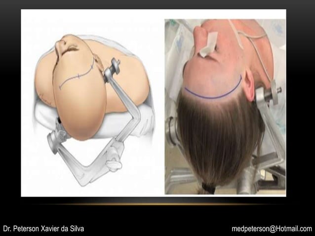 Craniotomia Pterional | PPTX | Surgery | Medical Health