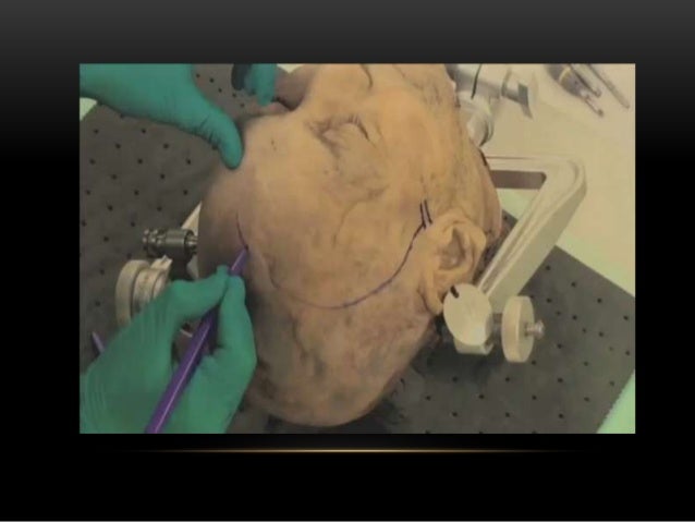 Craniotomia Pterional