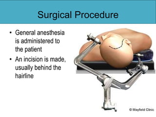 Craniotomy | PPTX