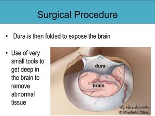 Craniotomy | PPTX