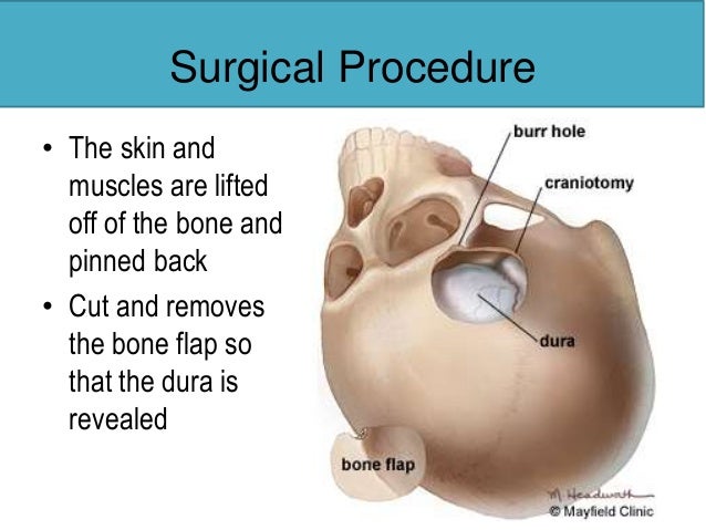 Craniotomy