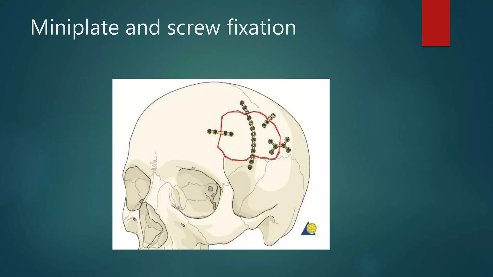 Operative instruments in Craniotomy | PPTX