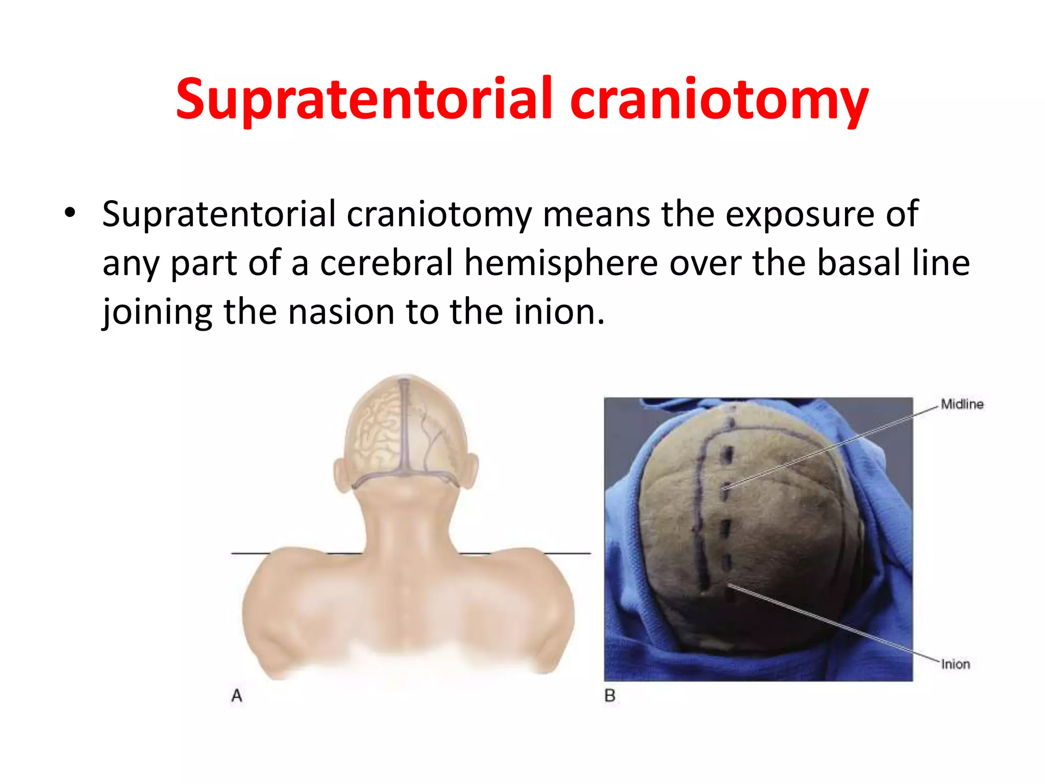 Craniotomy.pptx