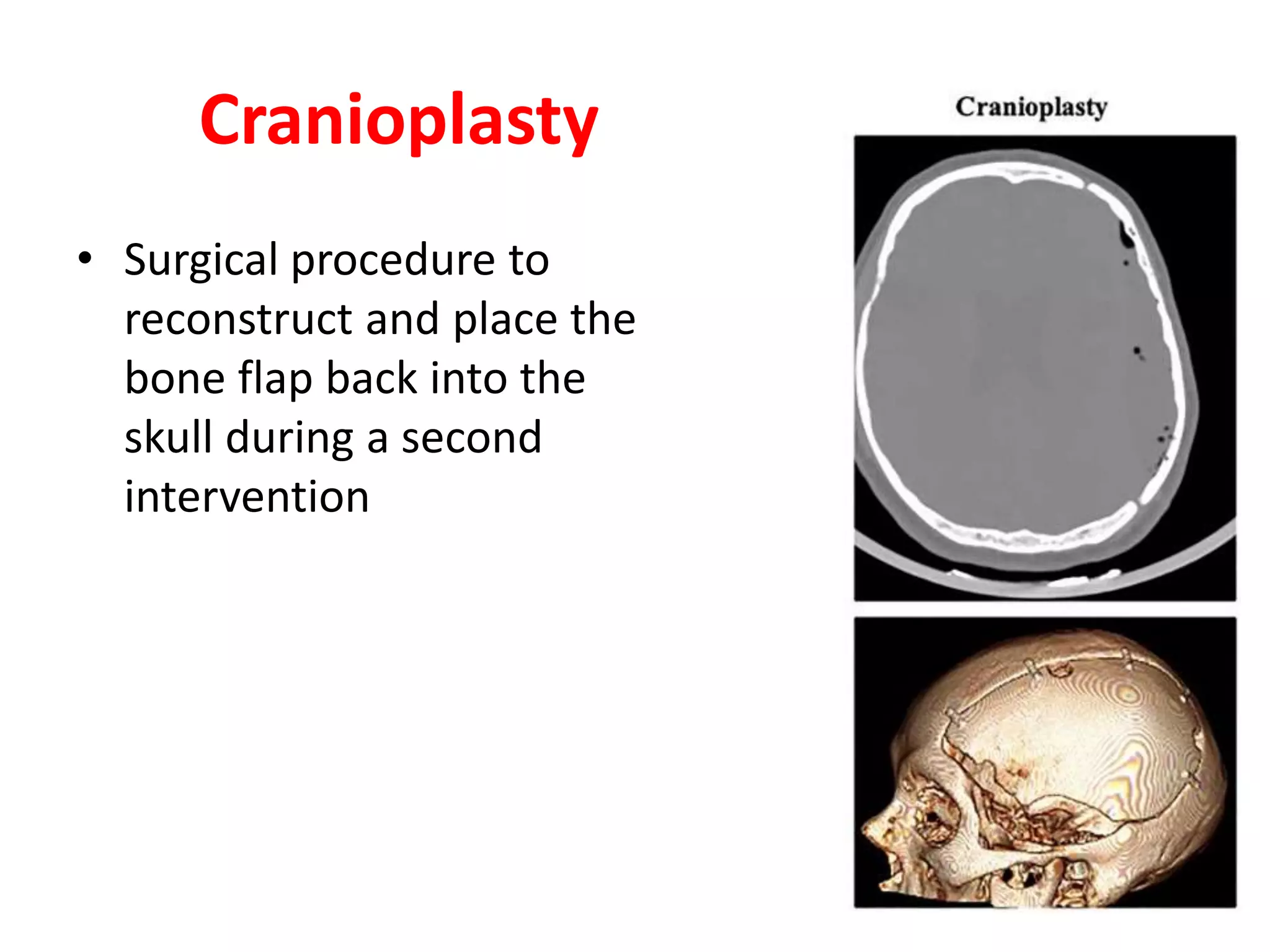 Craniotomy.pptx