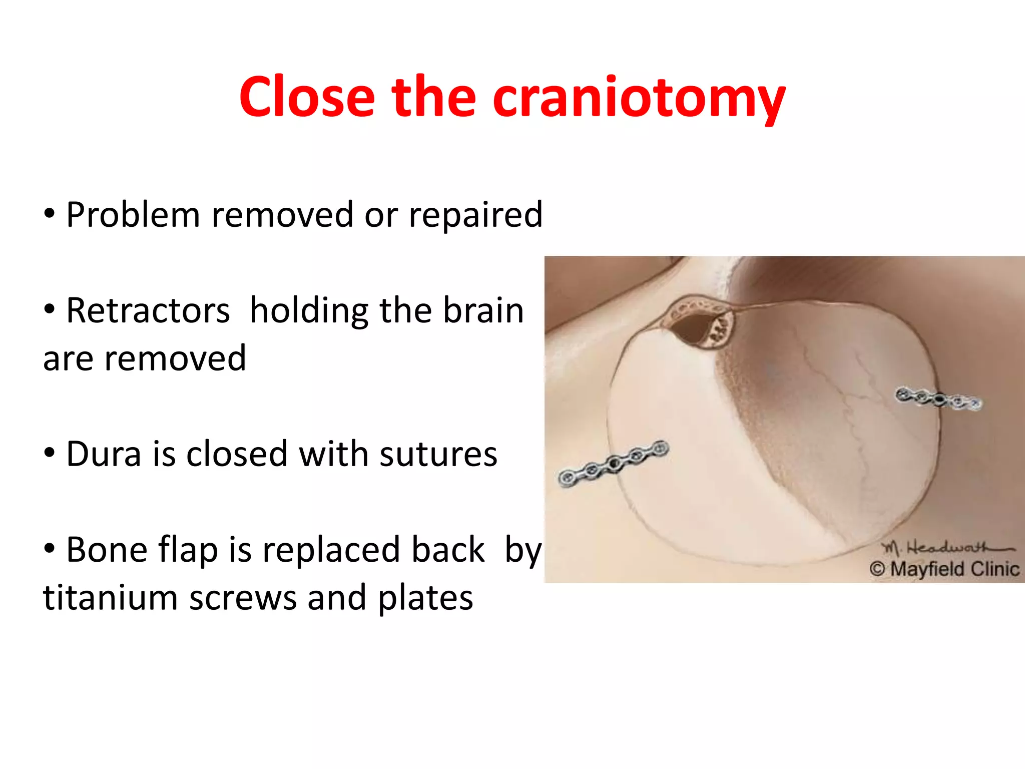 Craniotomy.pptx
