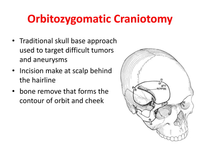 Craniotomy.pptx | Death, Injury, or Military Conflict | Sensitive Topics