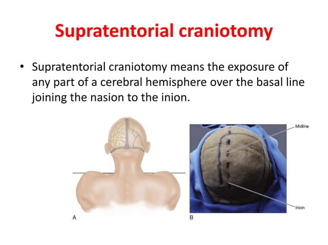 Craniotomy.pptx | Death, Injury, or Military Conflict | Sensitive Topics