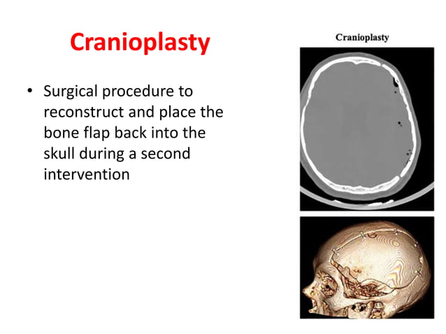 Craniotomypptx