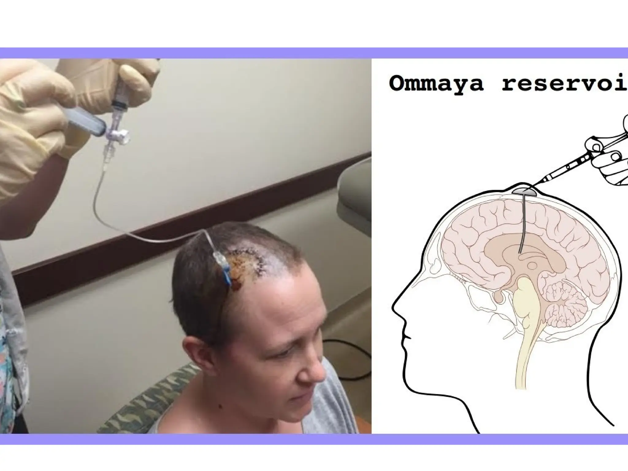 CRANIOTOMY and its nursing care management .pptx