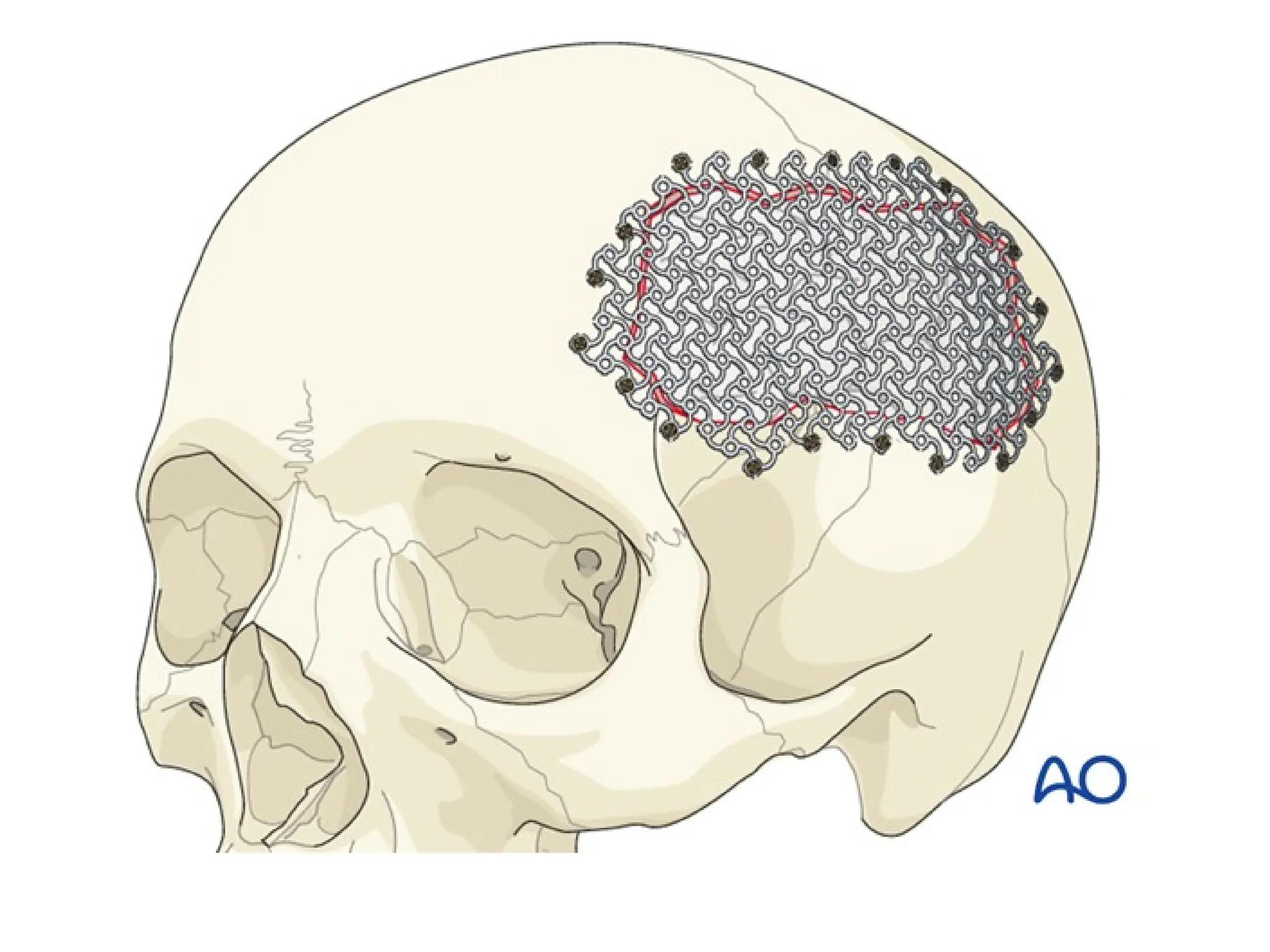 CRANIOTOMY and its nursing care management .pptx