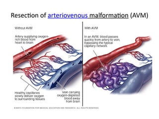 CRANIOTOMY and its nursing care management .pptx