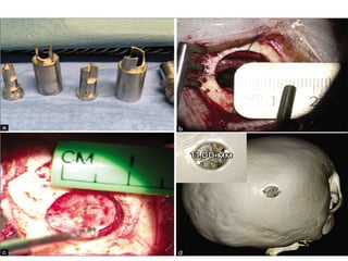 CRANIOTOMY and its nursing care management .pptx