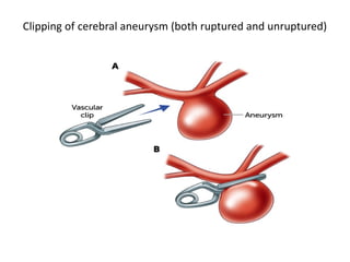 CRANIOTOMY and its nursing care management .pptx
