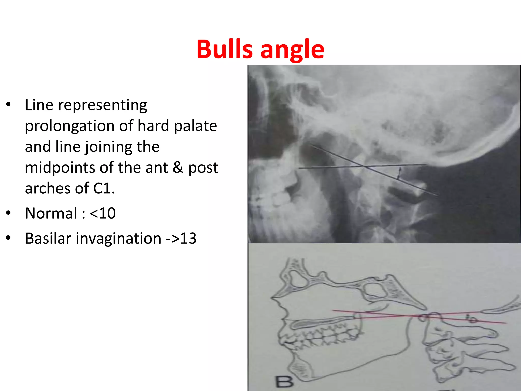Craniovertebral junction | PPTX