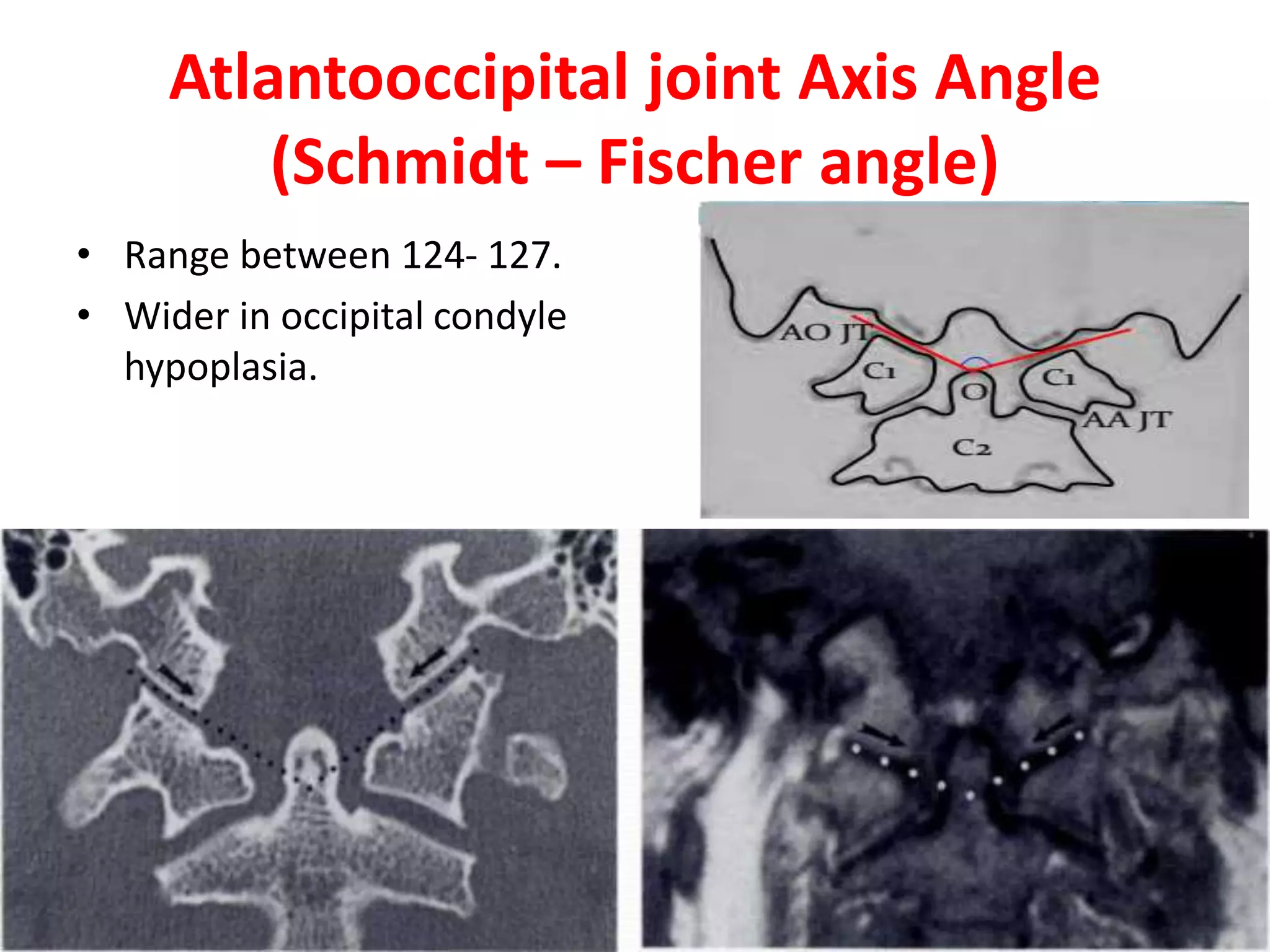 Craniovertebral junction | PPTX