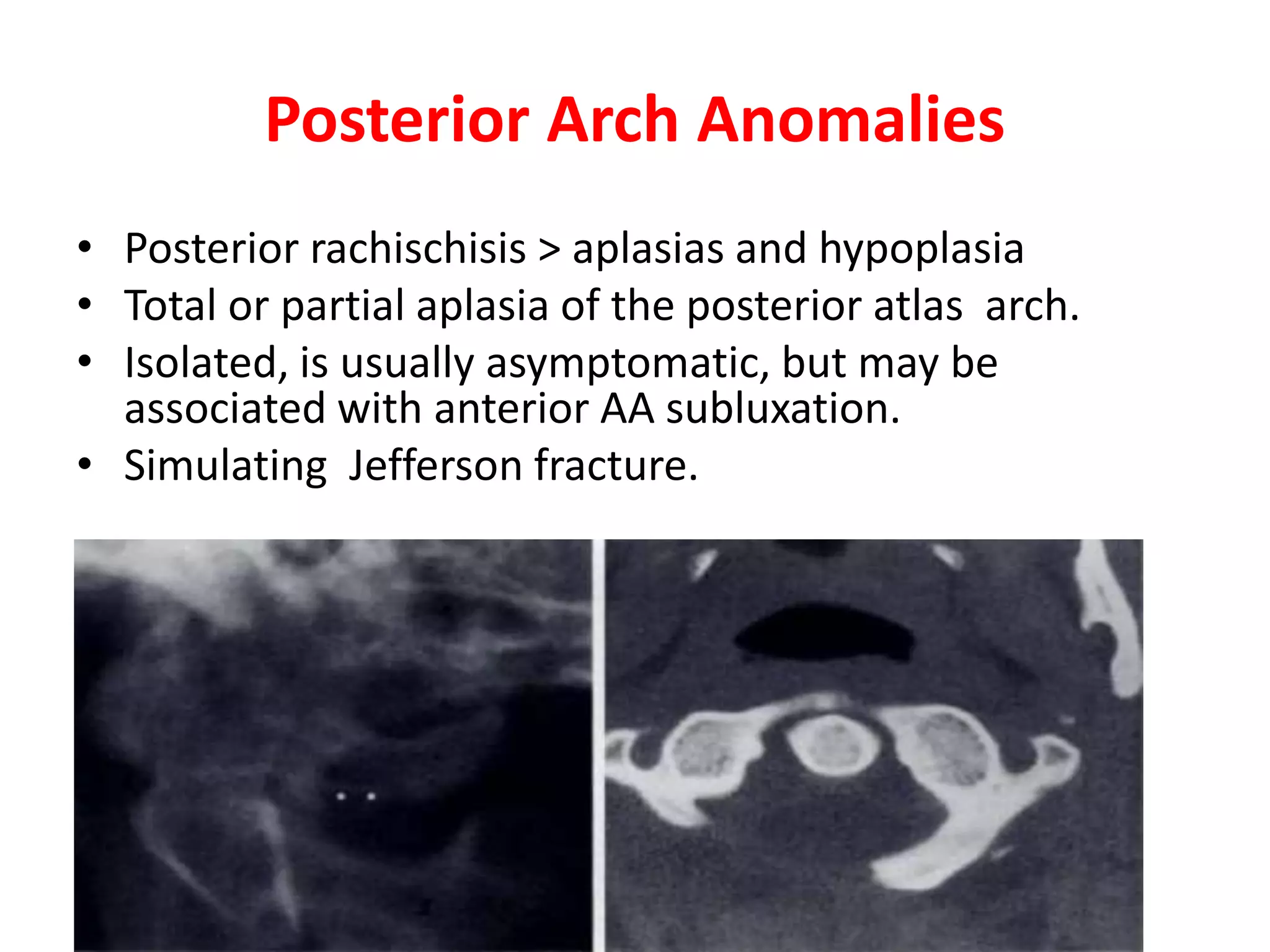 Craniovertebral junction | PPTX