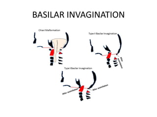 CRANIO VERTEBRAL JUNCTION ANAMOLY new (1).pptx