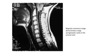 Craniovertebral junction anomaly | PPTX