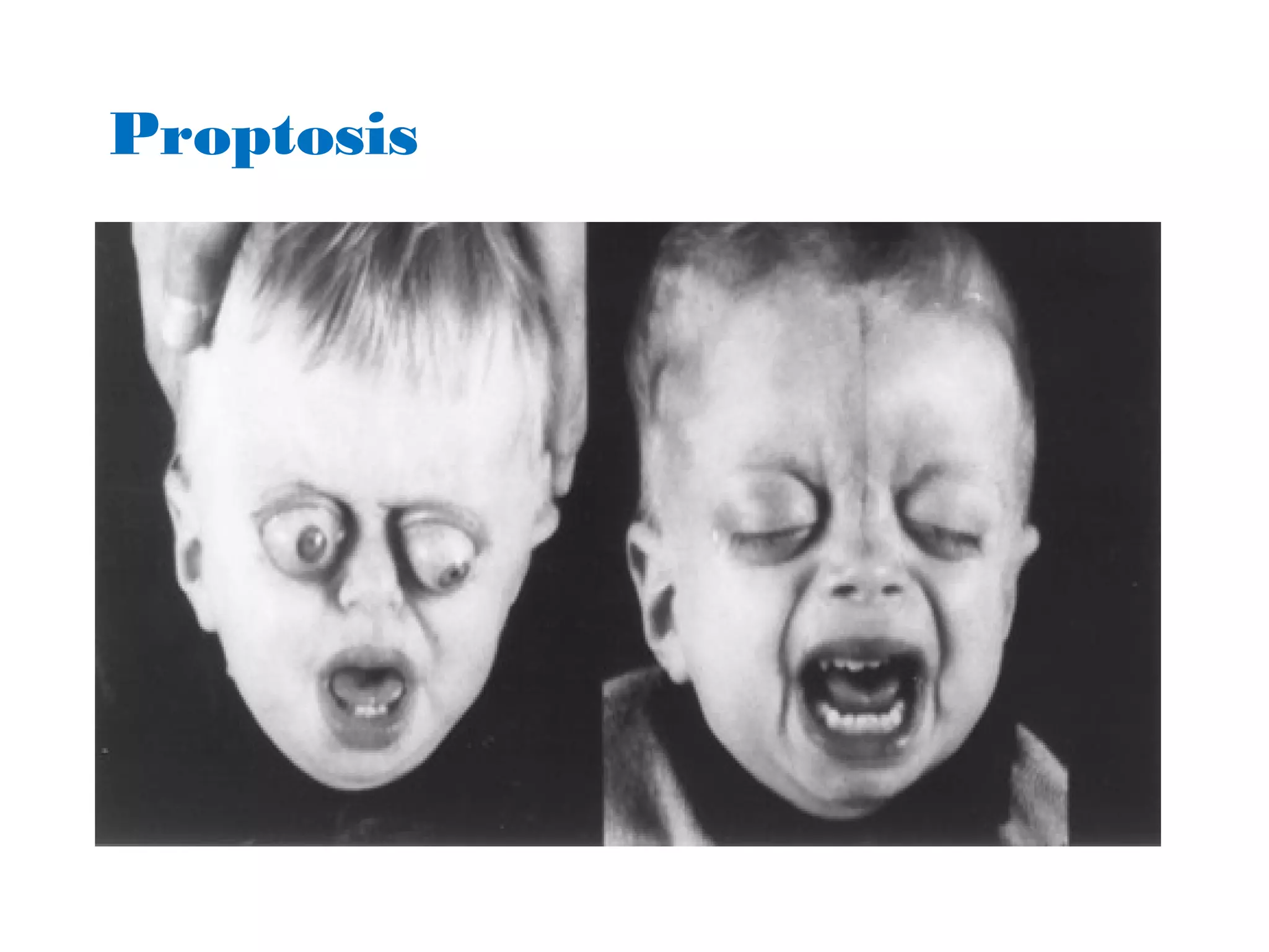 Cranoficial anomalies and craniosynostosis | PPT