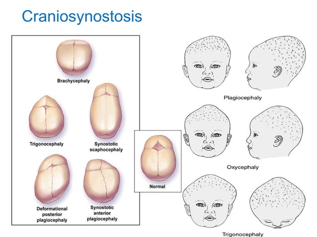 Cranoficial anomalies and craniosynostosis | PPT