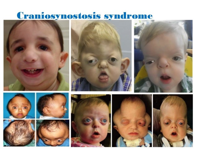 Cranoficial anomalies and craniosynostosis