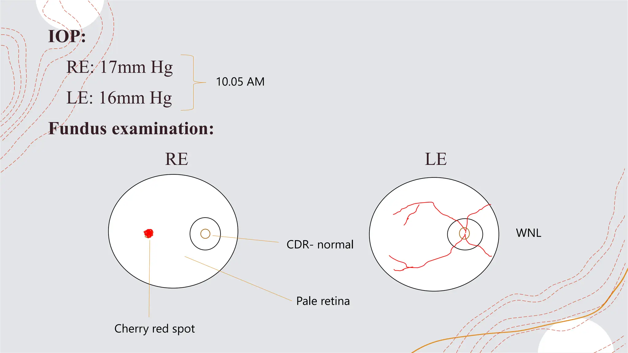 Central retinal artery occlusion | PPTX