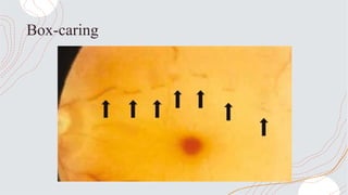 Central retinal artery occlusion | PPTX