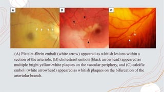 Central retinal artery occlusion | PPTX