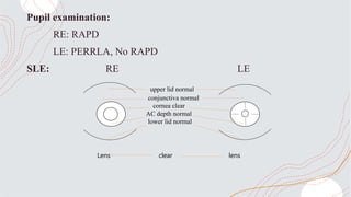 Central retinal artery occlusion | PPTX