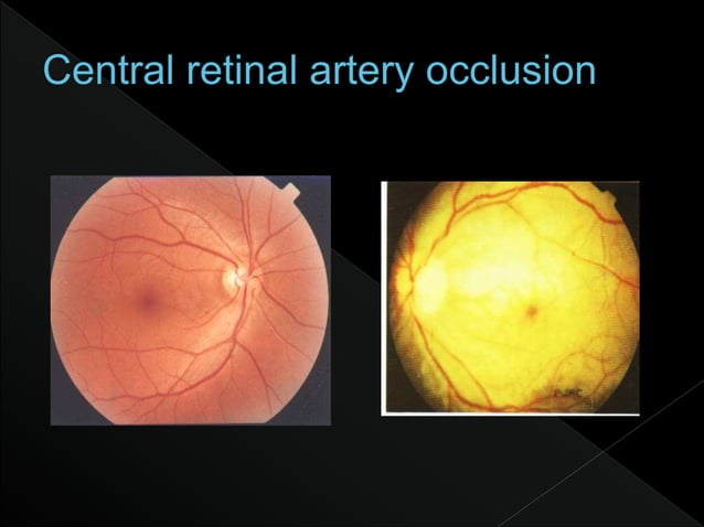 CRAO and BRAO | PPTX | Eye and Vision Conditions | Diseases and Conditions