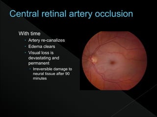 CRAO and BRAO | PPTX