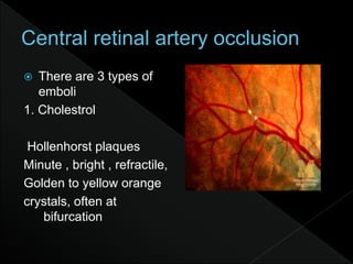 CRAO and BRAO | PPTX